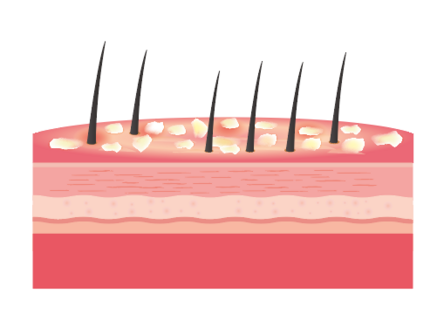 What is dandruff and seborrheic dermatitis - Nizoral